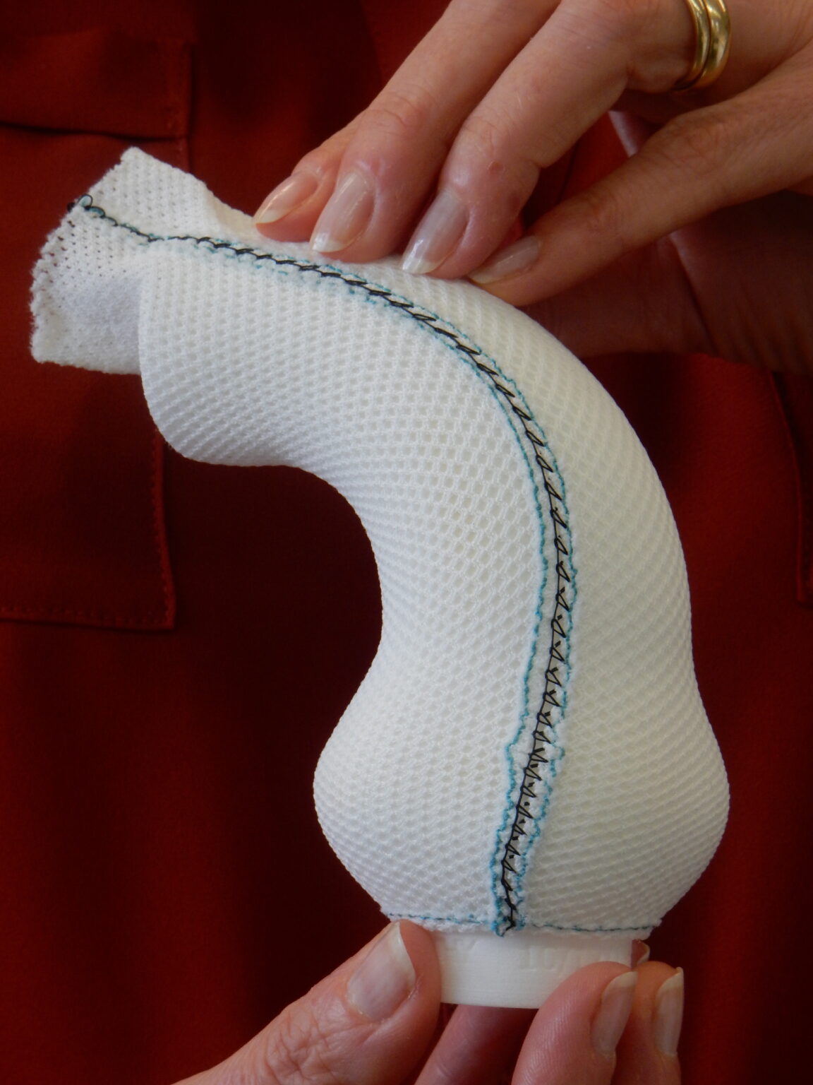 ExoVasc® reaches 750 patient milestone | eXstent