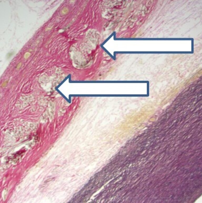 About the Aortic PEARS procedure | eXstent