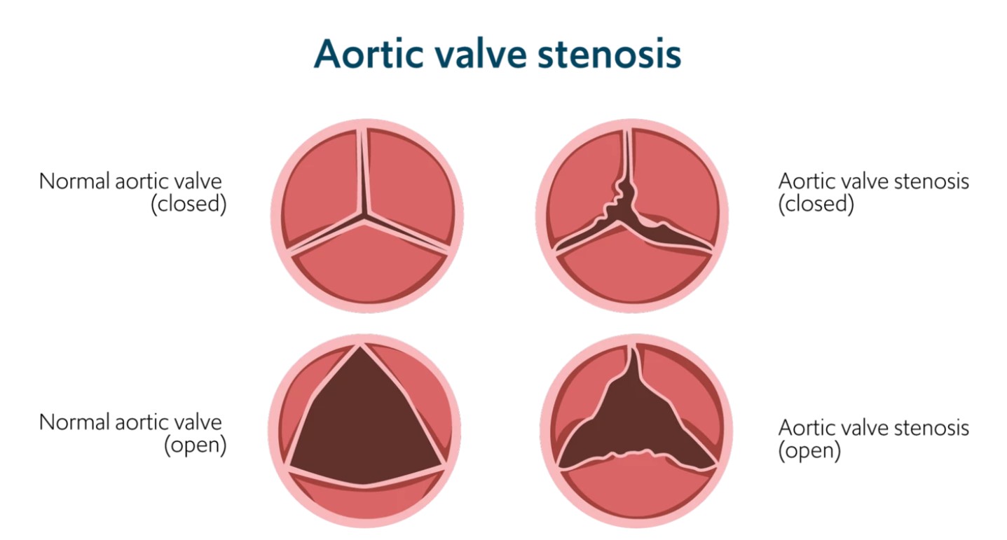 Aortic stenosis | eXstent